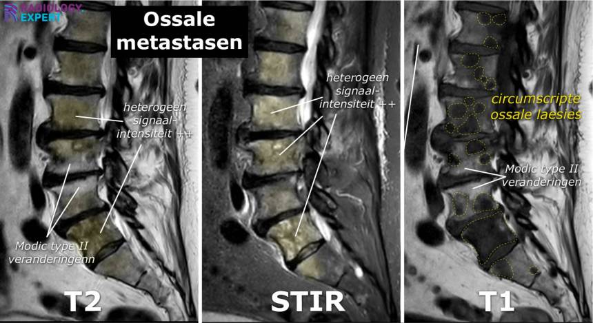 MRI lumbale wervelkolom